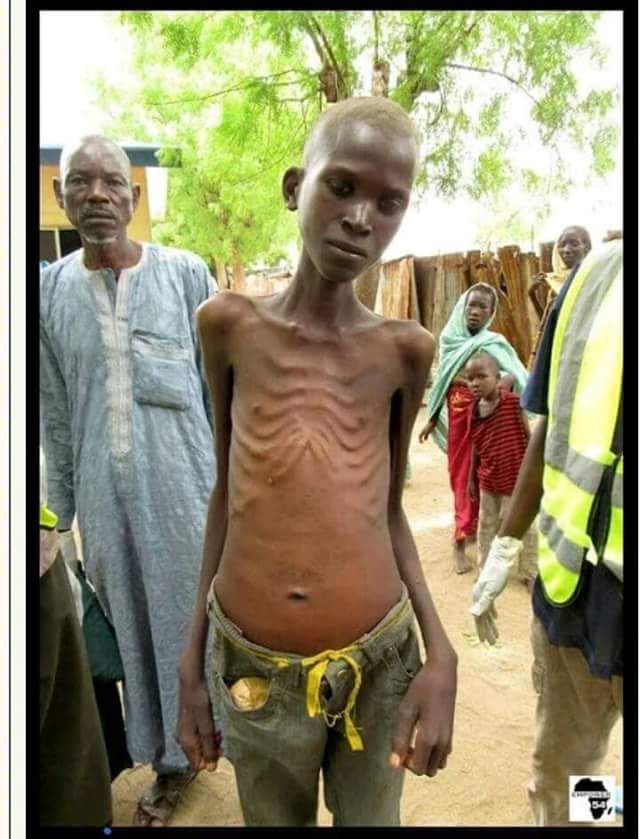 The Biafran: Boomerang! Kwashiorkor epidemics spreads across Northern ...