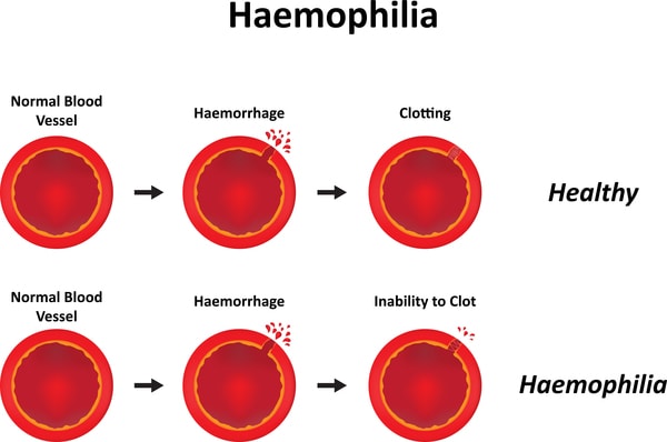 Medicose: Hemophilia facts