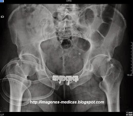 Sobre técnicas de imágenes médicas (Blog STIM): Radiografias de Pelvis ...