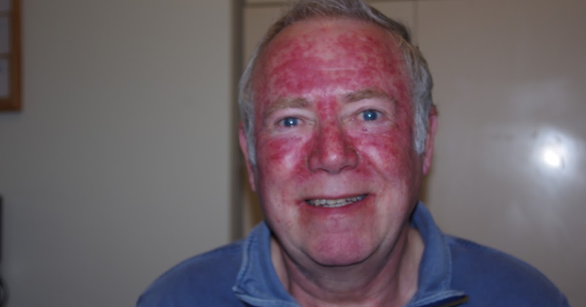 Alan's Efudix/Efudex Experience