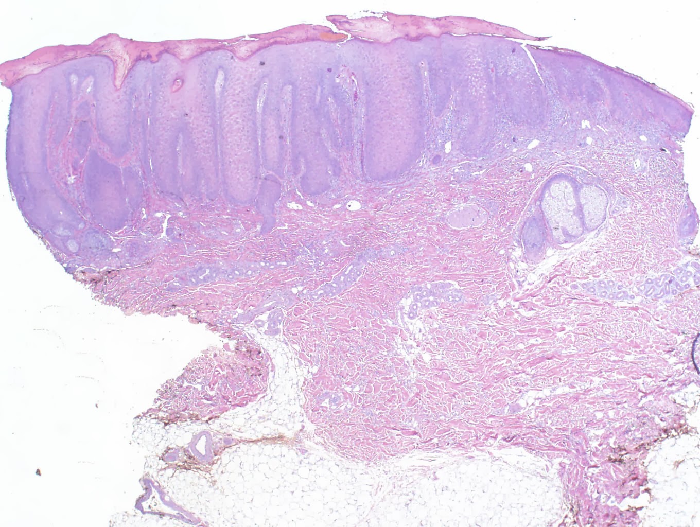 VIRTUAL GRAND ROUNDS IN DERMATOLOGY 2.0: Prurigo Nodularis with ...