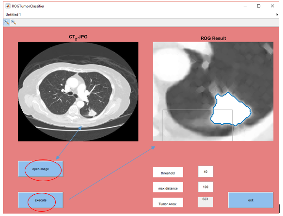 SEGMENTATION OF LUNG CT IMAGES AND NODULE DETECTION WITH MATLAB