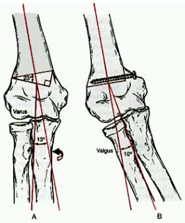 Biomecanica del MMSS: Biomecanica del Codo