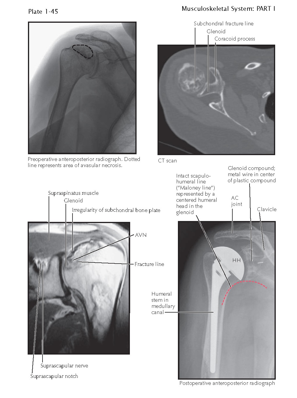 AVASCULAR NECROSIS OF THE HUMERAL HEAD - pediagenosis