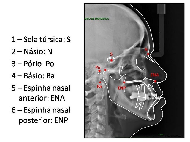 CIRURGIA E TRAUMATOLOGIA BUCOMAXILOFACIAL: Análise Cefalométrica - 2ª ...