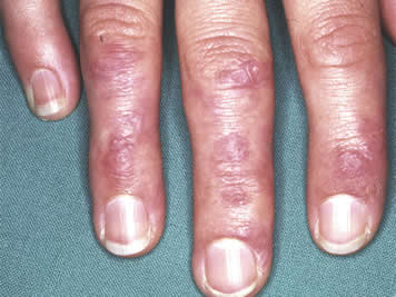 MedSemio: Dermatomiosite