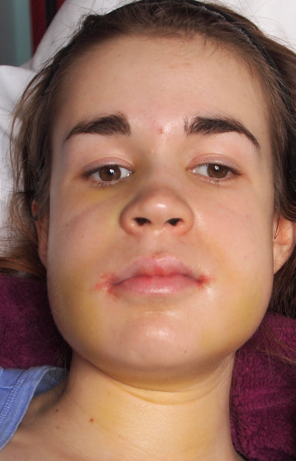 Rosa's Jaw Surgery Story: Day 5 since surgery