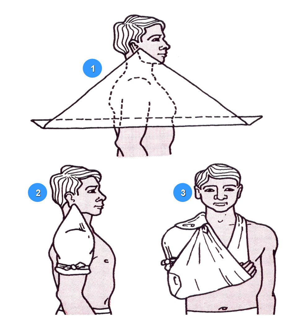 crescentsmexcel: Jenis-Jenis Balutan Luka