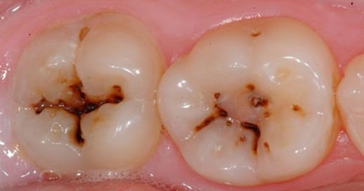 dental caries: dentistry