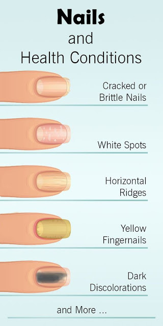 How Your Nails Warn You About Serious Health Conditions - medicine ...