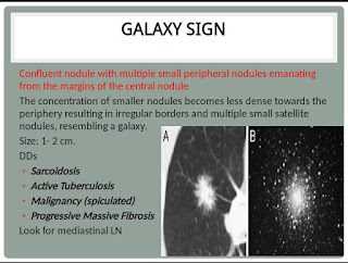 Chest Medicine Made Easy-Dr Deepu: Galaxy Sign
