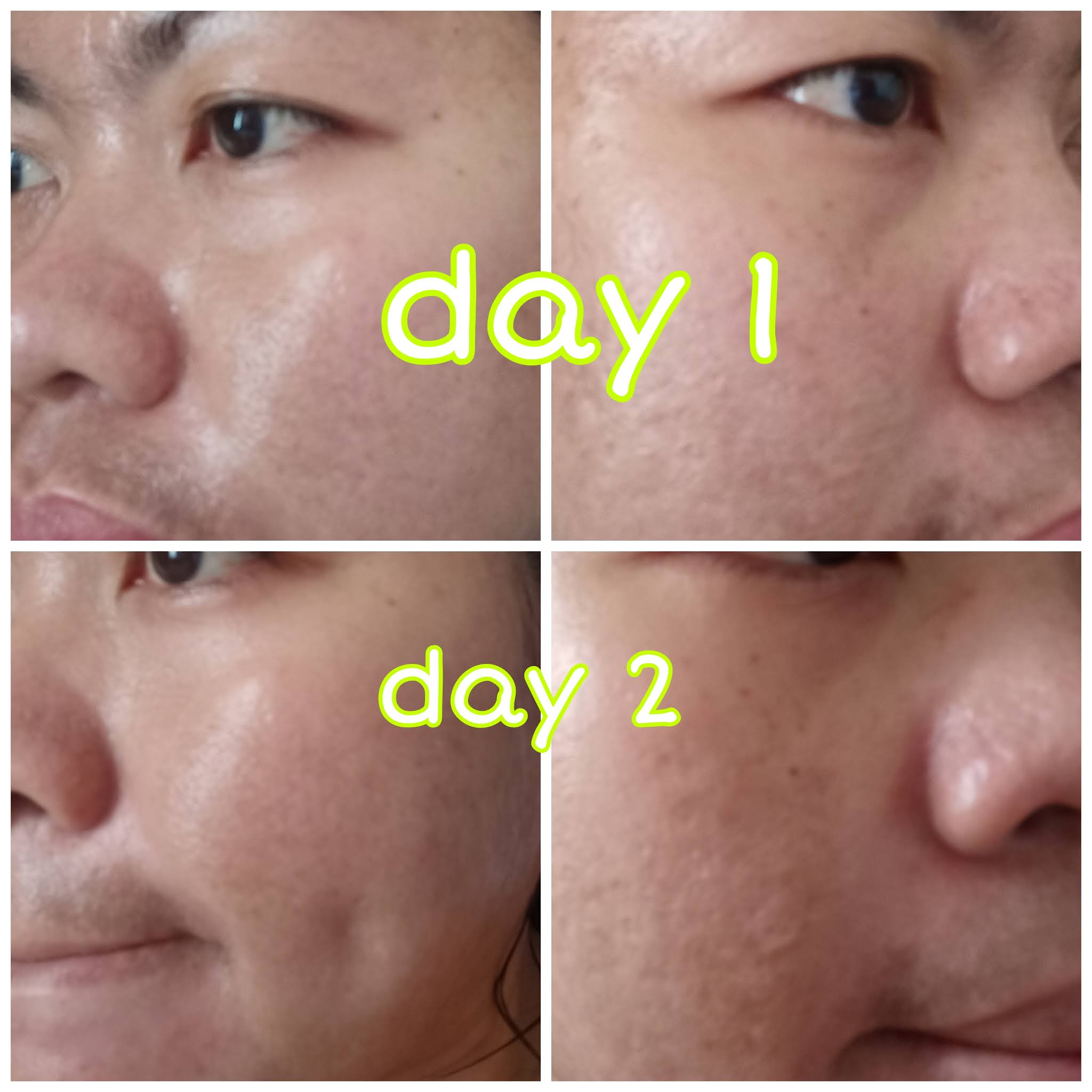 Flek Blocker Treatment ZAP Clinic Ampuh Cegah Flek Hitam Usia 40 Tahun