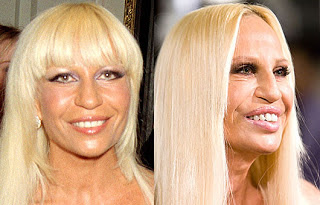 Donatella Versace Plastic Surgery Before and After Nose Job, Facelift ...