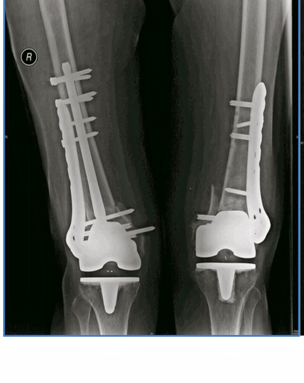 Joint Preservation and Replacement : periprosthetic fracture post tkr