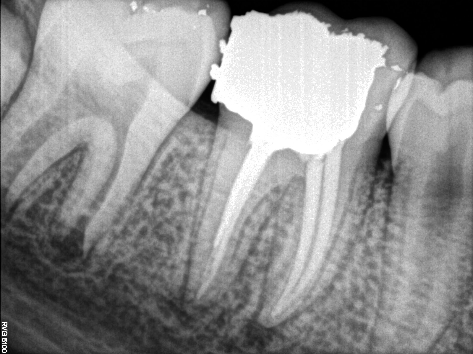 Endodontics: Postoturation restoration / Restoration after obturation