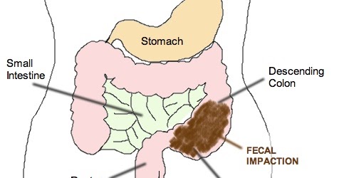 Malicious Intent: Extreme Fecal Impaction - Music from the BOWELS of Hell!!