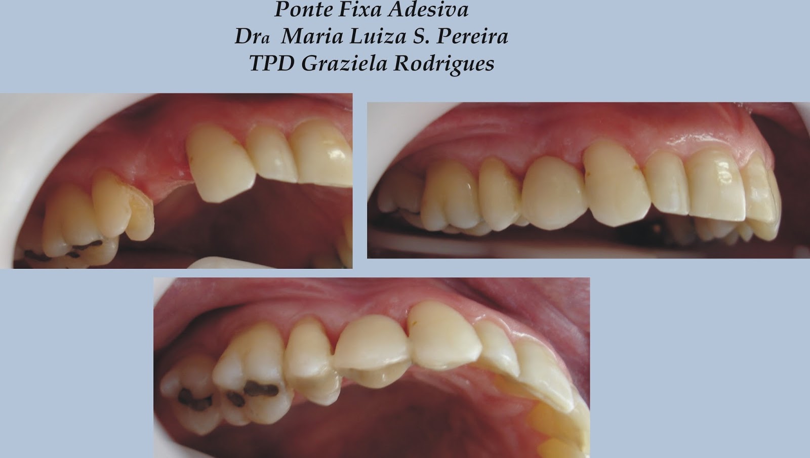 SORRISO! : Ponte Fixa Adesiva