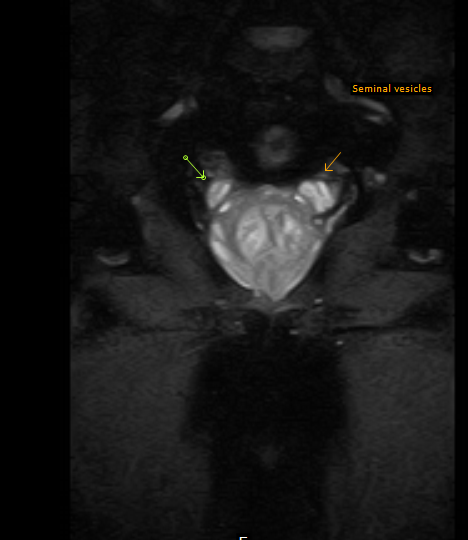 Benign prostatic hypertrophy-MRI - Sumer's Radiology Blog