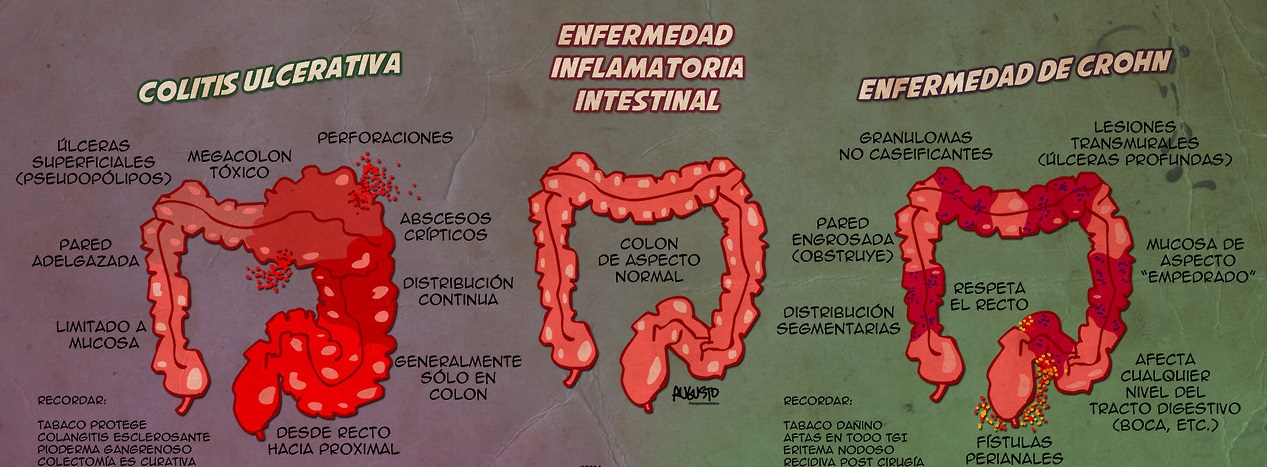 CROHN vs CUCI aprende a diferenciarlas de una manera fácil + VIDEO. - Medicina mnemotecnias