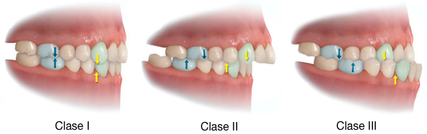 Epilepsia: Maloclusión