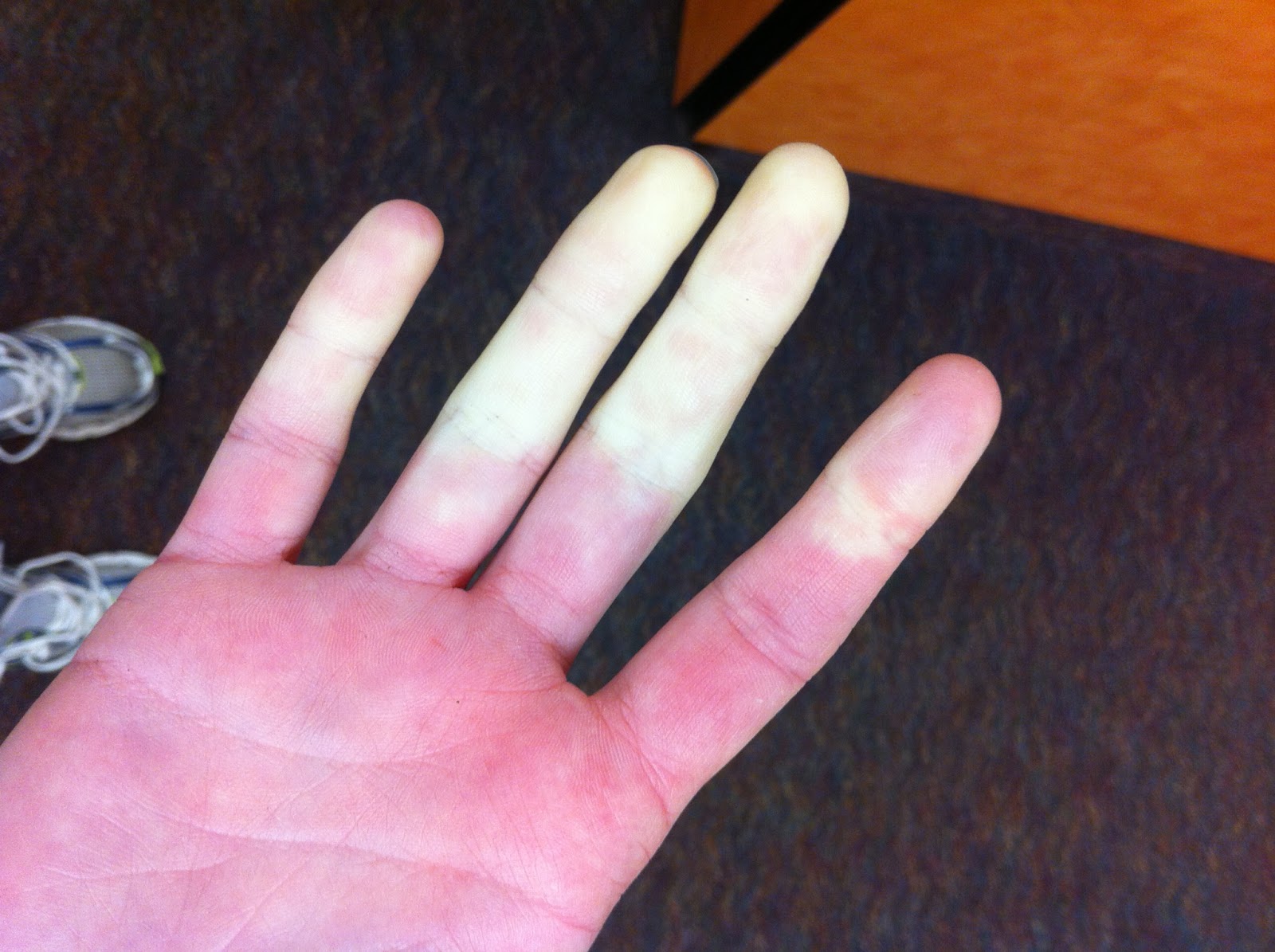 Morning Runner: Raynaud’s Disease