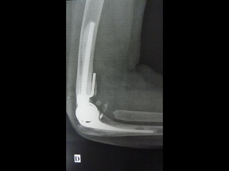 FRACTURES DE LA PALETTE HUMÉRALE (Fractures de l’extrémité inferieure ...