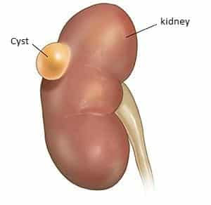 Kidney cysts (Renal Cysts) and Treatment
