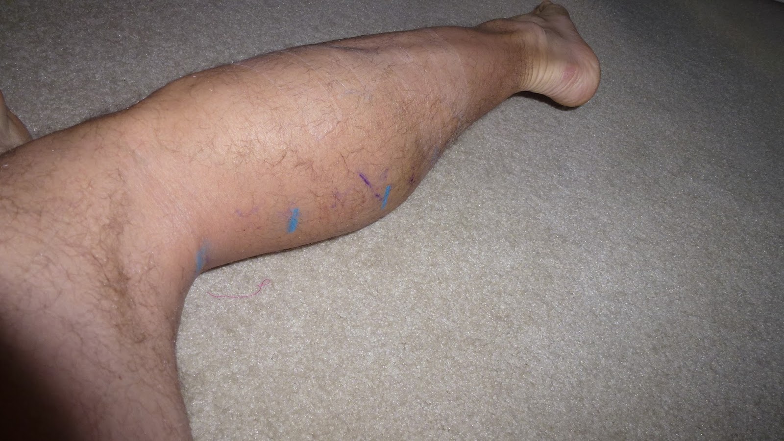 Removal of GSV and LSV of a moderate level distance runner with venous ...