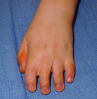 Symbrachydactyly | Congenital Hand and Arm Differences | Washington ...