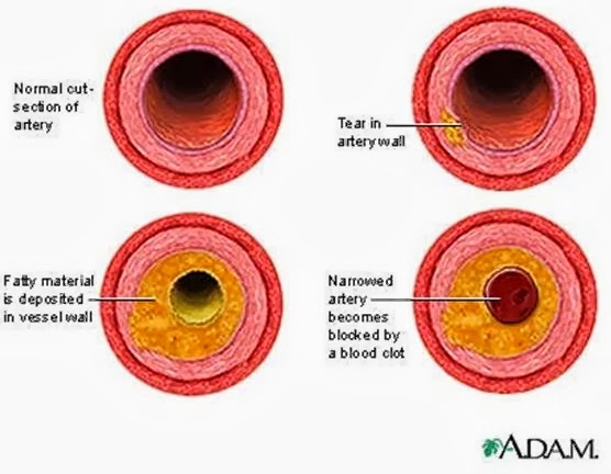 Infark Miokard Akut (IMA), Myocardial Infarction Medical Articles