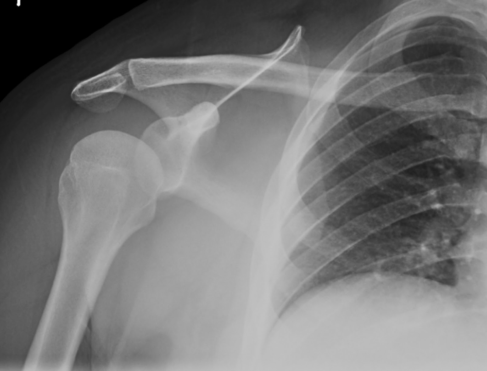 Doc Cottle's Desk: Is the shoulder in? Use ultrasound!