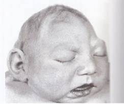 Macrocefalia e Microcefalia | A minha alma canta