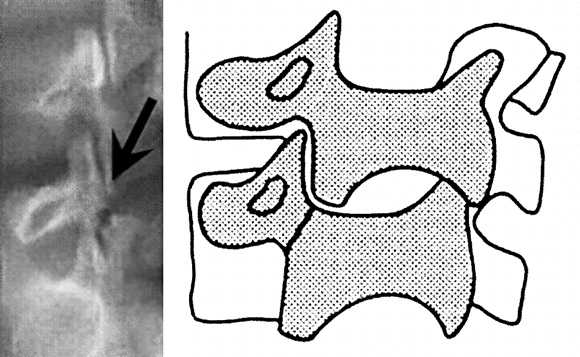 Spondylolysis or Pars Fracture | Growing Spine Blog | Washington ...