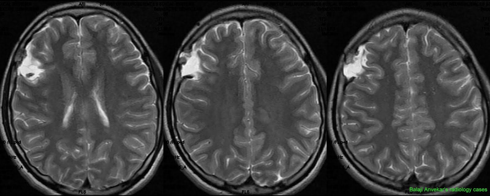 Dr Balaji Anvekar FRCR: Post Traumatic Leptomeningeal Cyst MRI
