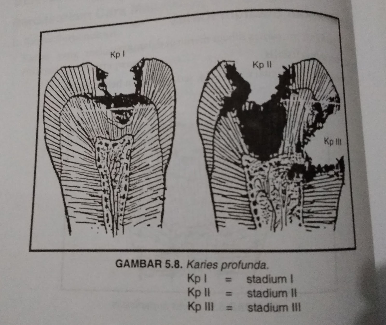 Karies Gigi Berdasarkan Stadium Karies dan Cara Meluasnya