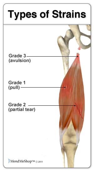 Pertolongan Pertama pada Sprain dan Strain