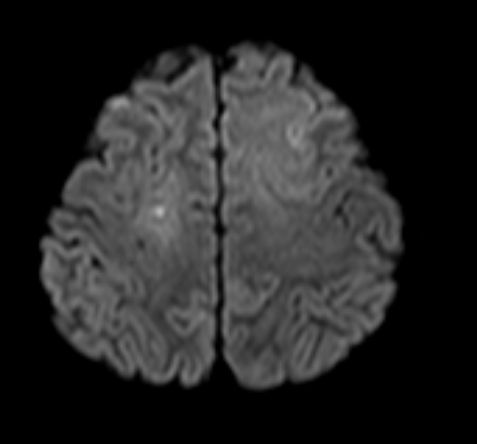 Dengue Hemorrhagic Fever-MRI - Radiology Imaging
