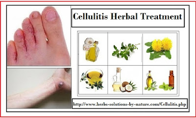 Cellulitis Herbal Treatment with Essential Herbs