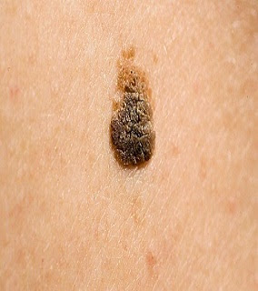 How To Remove A Mole: What Are the 3 Main Attributes of Warts?
