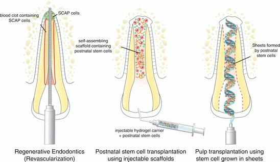 Pulp Revascularization