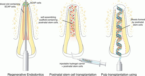 Pulp Revascularization