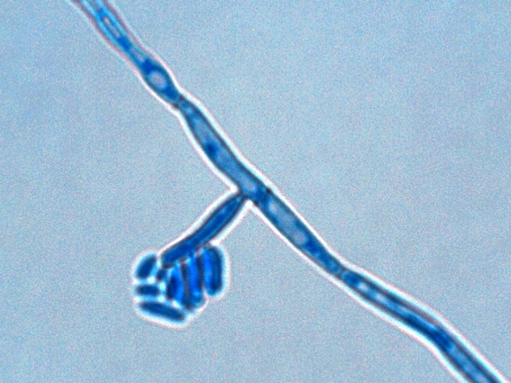 Fun With Microbiology (What's Buggin' You?): Exophiala dermatitidis