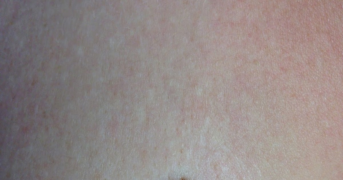 dermoscopy: A pigmented lesion on a shoulder