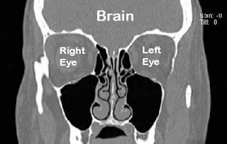 Ct Sinus Anatomy