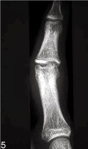 Tom's Physiotherapy Blog: Youngsters: Epiphyseal Plate Injuries