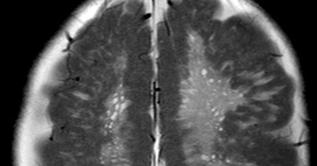 Cobblestone lissencephaly-MRI - Sumer's Radiology Blog