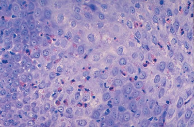 Histopatología: PATOLOGÍA DEL ESÓFAGO Y ESTOMAGO