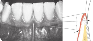UNIDAD III: Encía Periodontológica