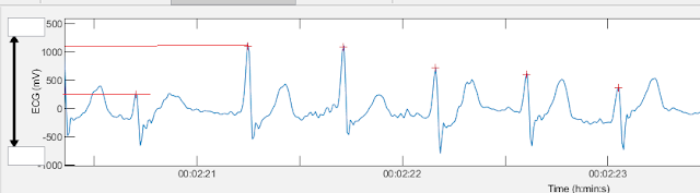 Muscle Oxygen Training: ECG artifact strips from Fatmaxxer - a guide