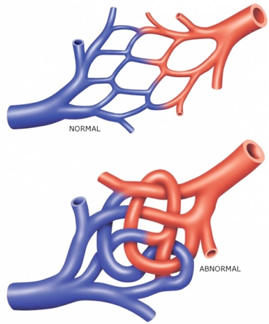 My Bout with Cerebral AVM: AVM 101